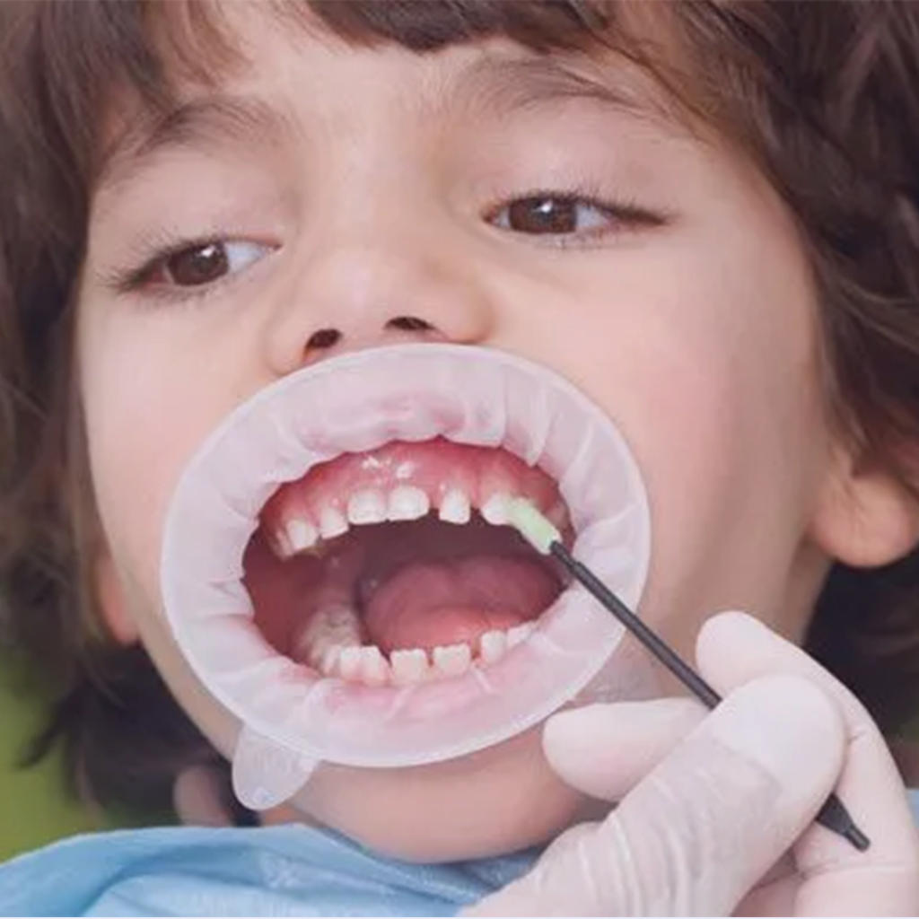 Fluoride Application for Kids - NCDC