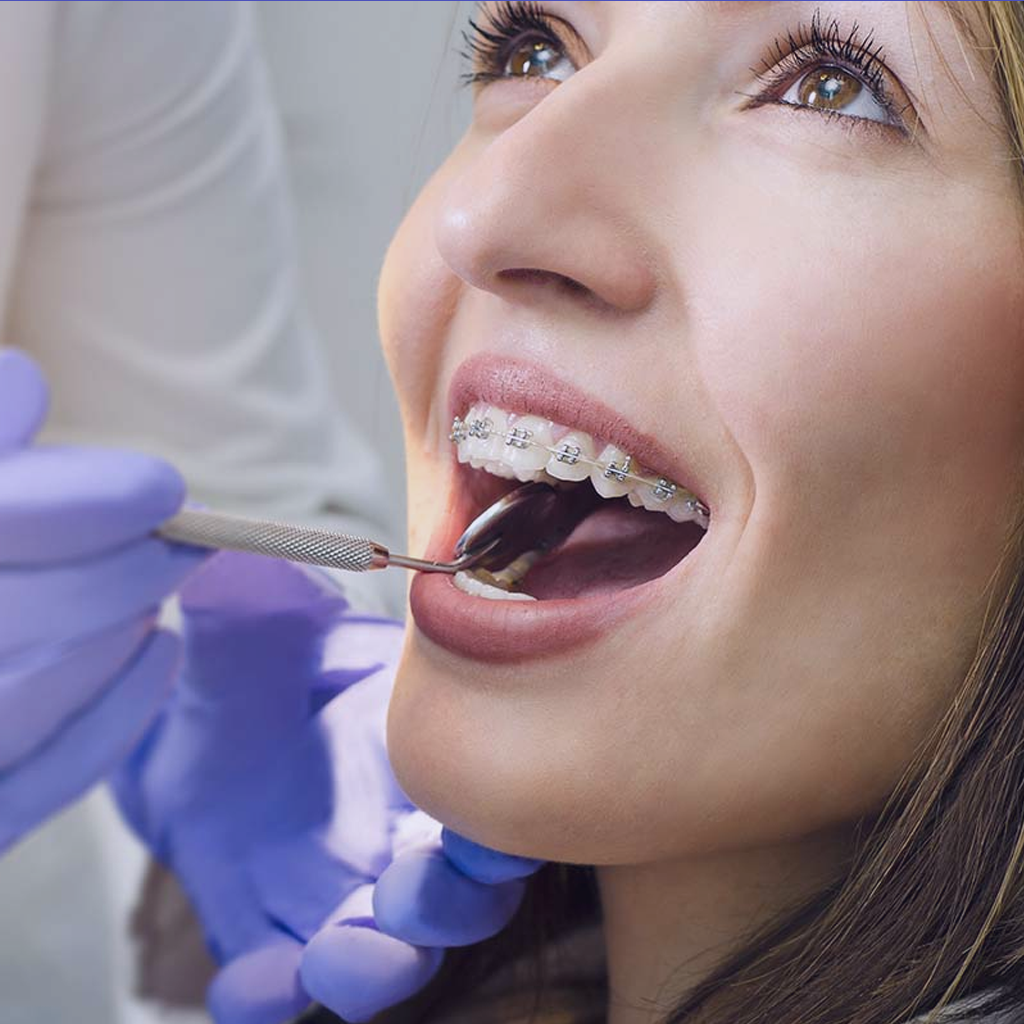 Braces (Installation & Adjustments) - NCDC